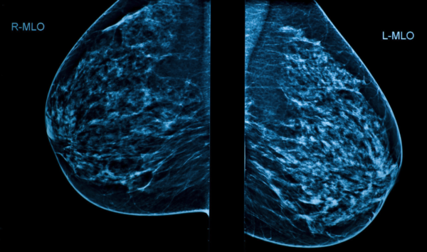 What to Expect During a Mammogram | Infinity Medical Clinic