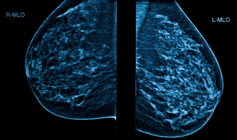 What to Expect During a Mammogram | Infinity Medical Clinic